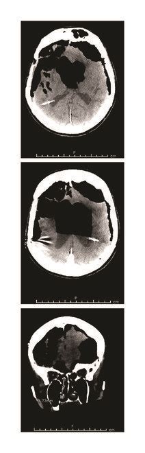 Ct Brain Scan Shows Large Amount Of Intracranial Free Air And Bony