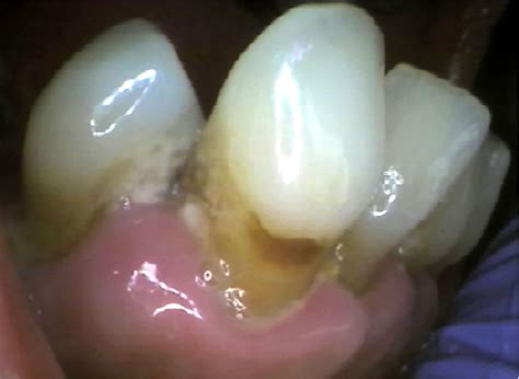 Root Caries