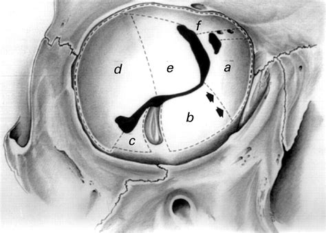 Endoscopic Medial Orbital Wall Decompression At Kathryn Ono Blog