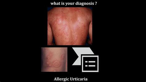 Symphony Of Allergy In Dermatology Ppt Download