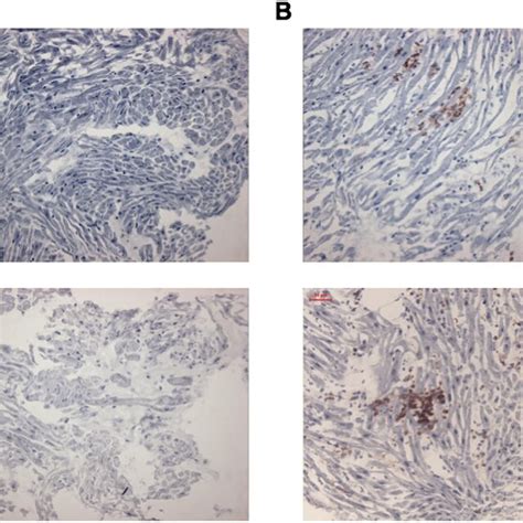 Immunohistochemical Staining Of Cd3⁺ Lymphocytes In Endomyocardial