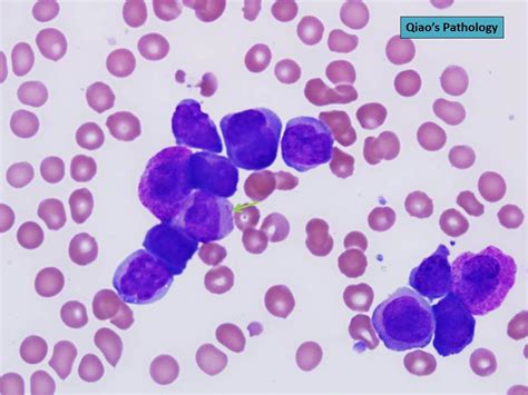 Myeloblast Vs Promyelocyte