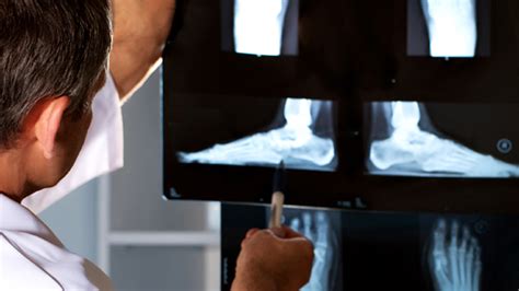 Inflamed Ankle Synovitis Ankle Treatment Washington Dc Maryland Virginia Medstar Health