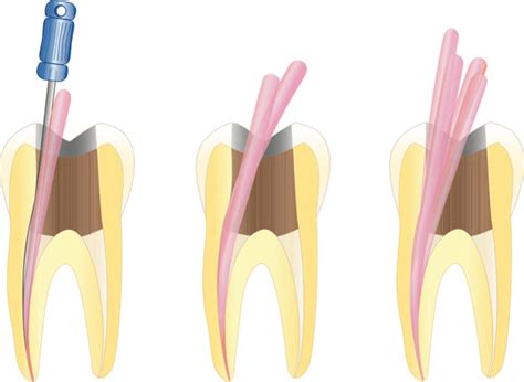 Step 4 Filling The Apical Portion Lateral Or Vertical Compaction
