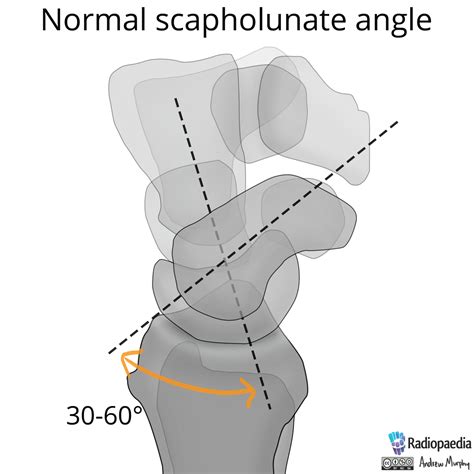 Filenormal Wrist Alignment Dorsal And Volar Intercalated Segmental