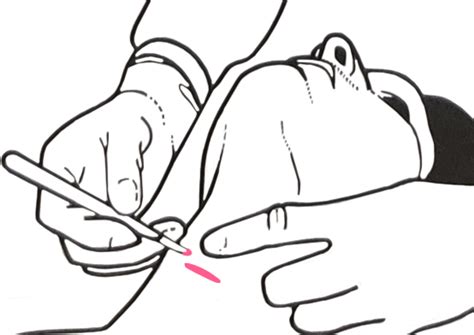 Набор 100461000 Mini Trach Ii для минитрахеостомии