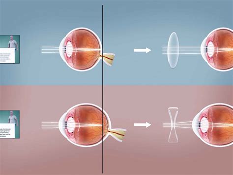 Refractive Errors Myopia Hyperopia And Astigmatism