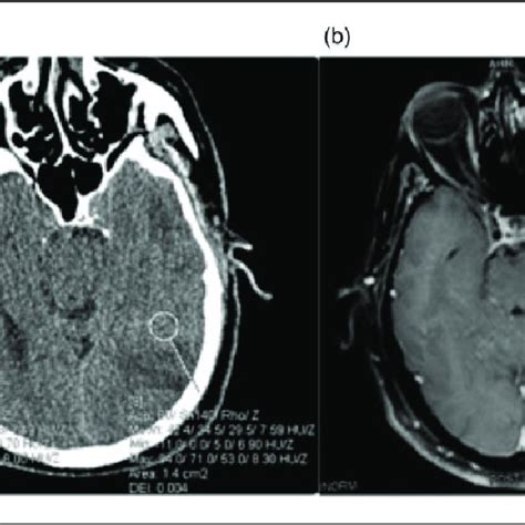 A Case Of Left Temporal Lobe Gliosarcoma Who Grade 4 A