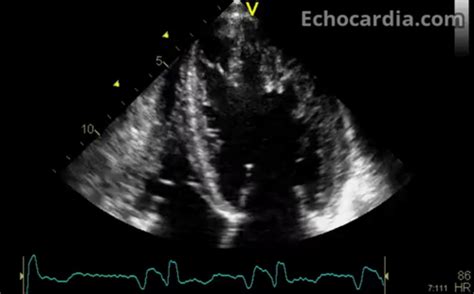 Basic Echo Lv Non Compaction Powerpoint Takotsubo Cardiomyopathy Flashcards Quizlet