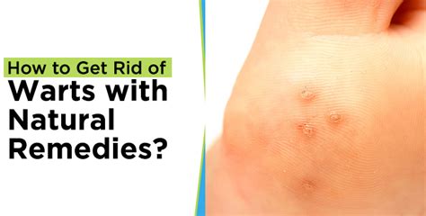 How To Get Rid Of Warts With Natural Remedies