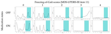 An Explainable Spatial Temporal Graphical Convolutional Network To Score Freezing Of Gait In