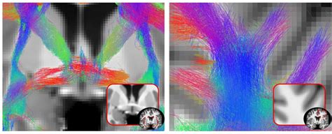 Doris A Diffusion Mri Based 10 Tissue Class Deep Learning Segmentation