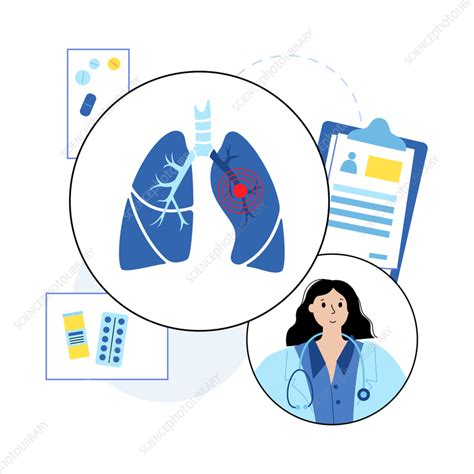 Pulmonary Embolism Treatment Illustration Stock Image F036 6457
