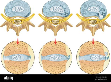 Herniated Nucleus Pulposus Stock Vector Images Alamy