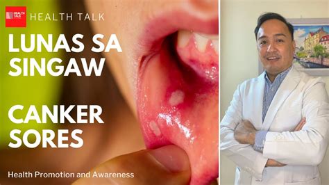 Amazing Tips About How To Prevent Singaw Storyhigh