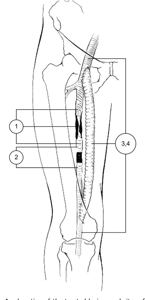 Figure 1 From Use Of Wave Intensity Analysis During Peripheral