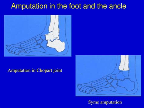 Ppt Amputation Powerpoint Presentation Free Download Id9490838