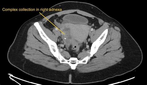 Ct Case 024 • Litfl • Ct Scan Interpretation