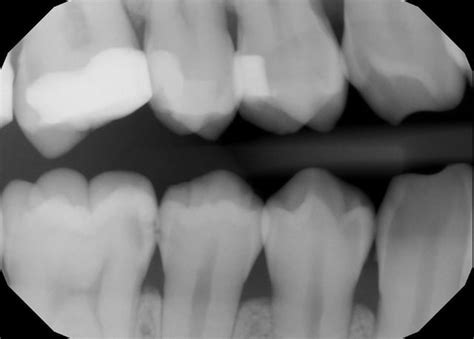 Root Canal And Crown Vs Just Crown Raskdentists