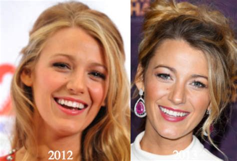 Blake Lively Plastic Surgery Before And After Photos