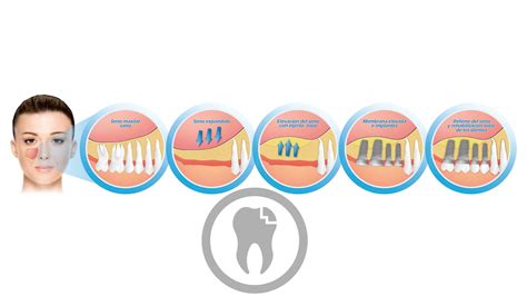 What Is The Maxillary Sinus Odontosoat