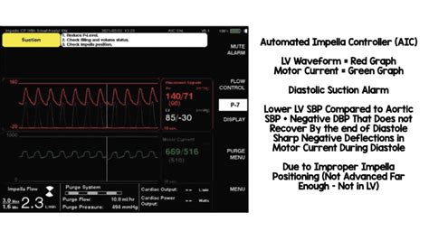 Impella Devices 101 Rebel Em Emergency Medicine Blog