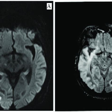 A F Brain Mri Images At First Presentation With Hsv Encephalitis A