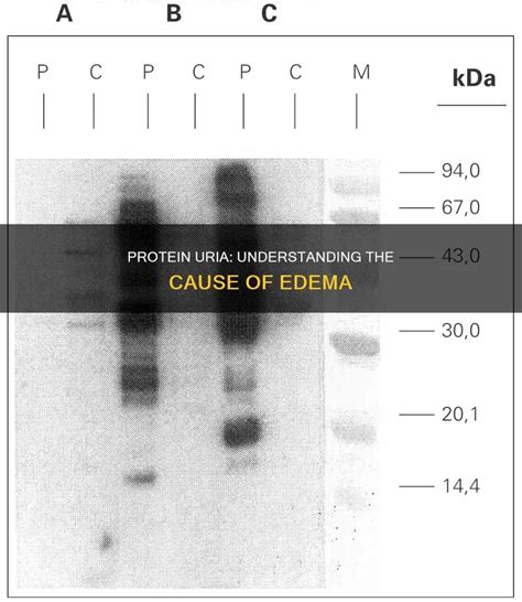 Protein Uria Understanding The Cause Of Edema Medshun