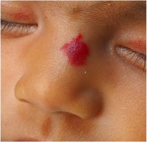 Dermatology Images Infantile Hemangioma Journal Of The American