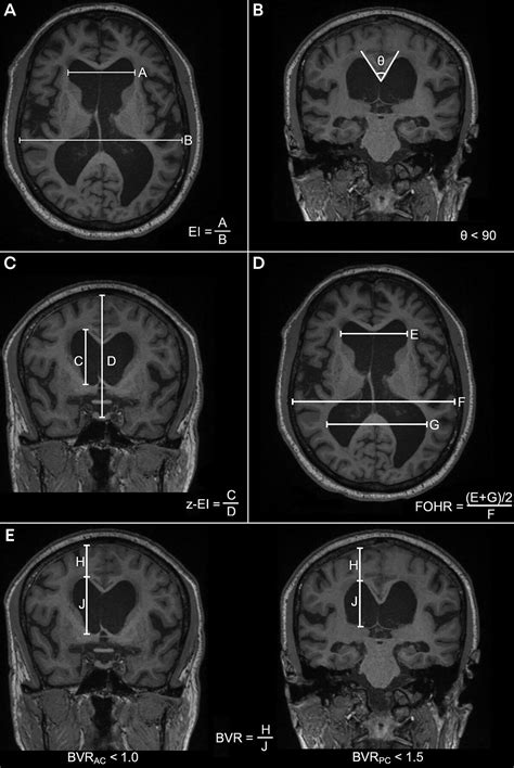 Hydrocephalus Mri Radiology