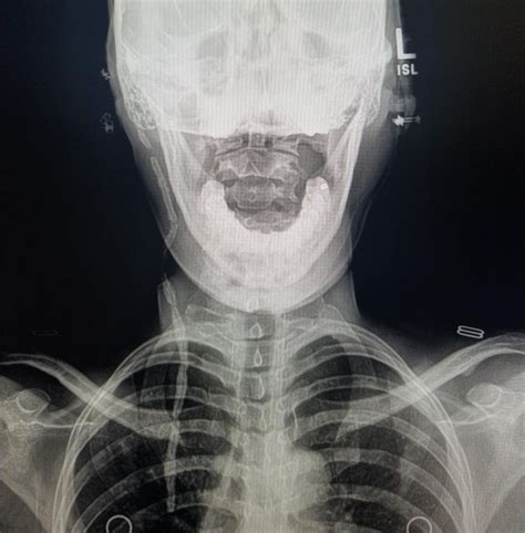 Diagnostic Calcification Of A Vp Ventriculoperitoneal Shunt A Rare