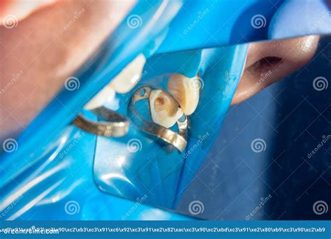 Two Chewing Side Teeth Of The Upper Jaw After Treatment Of Caries