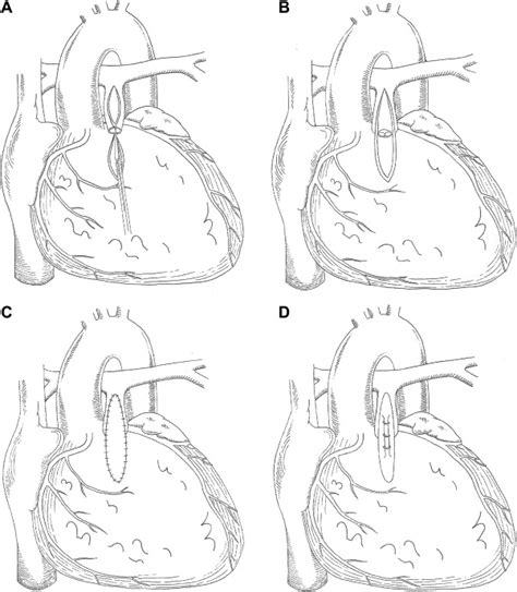 Tetralogy Of Fallot Repair How I Teach It The Annals Of Thoracic Surgery