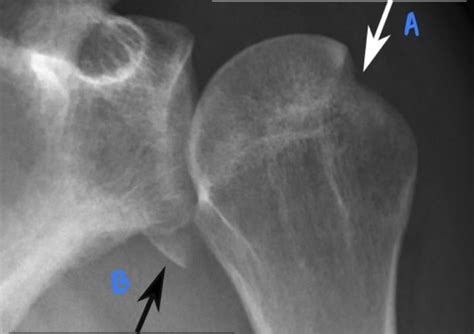 Msk Shoulder Flashcards Quizlet