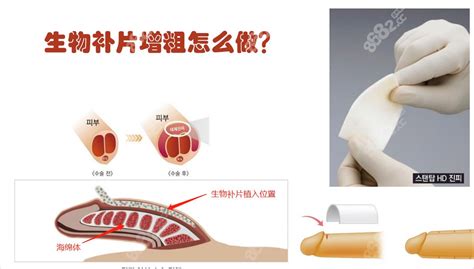 生物补片4x6增粗多少厘米一次可以放几层手术价格也说说呗修复对比照 8682整形网