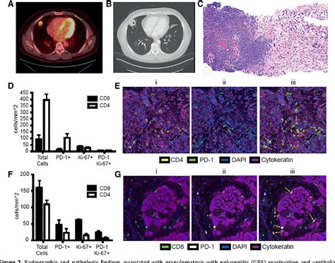 Figure 1 From Anti Pd 1 Immunotherapy Induced Flare Of A Known