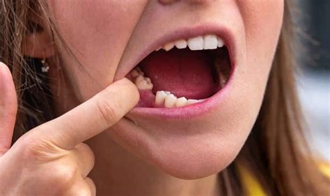 Why Implants Are The Best Way To Replace Missing Teeth