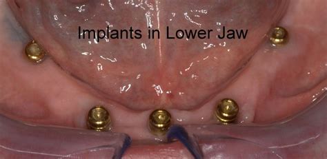 Lower Implant Denture Dental Implants Before And After Gallery