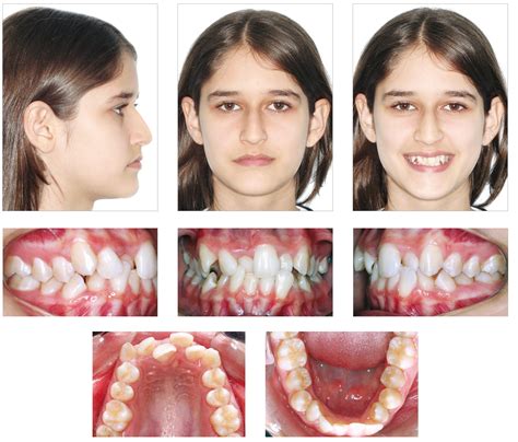 Scielo Brasil Class I Malocclusion With Anterior Crossbite And Severe