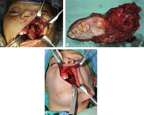 A Perisurgical Cuts Of The Left Maxillectomy B Maxillectomy Download Scientific Diagram