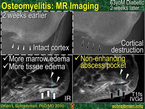 Ppt Osteomyelitis Powerpoint Presentation Free Download Id495462