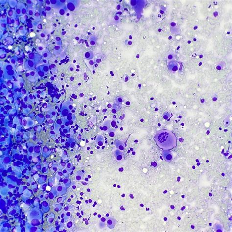 Lymph Node Fna Rpathology