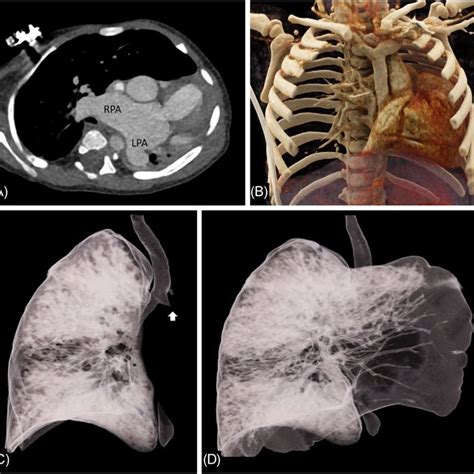 Frequency Of Mapcas In Patients With Tof Or Tof Pa Depending On The Download Table