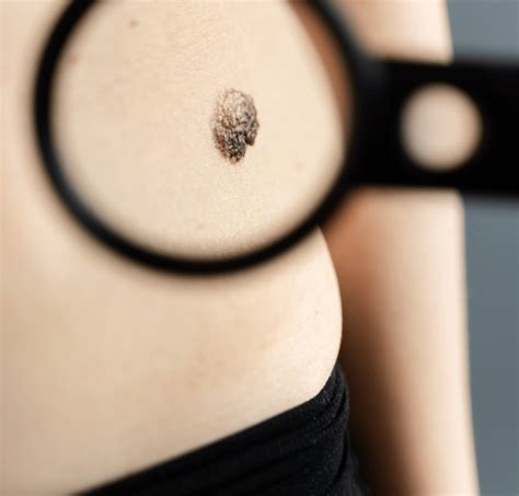 13 Surprising And Common Skin Indicators Of Diabetes Diabetes Fixer