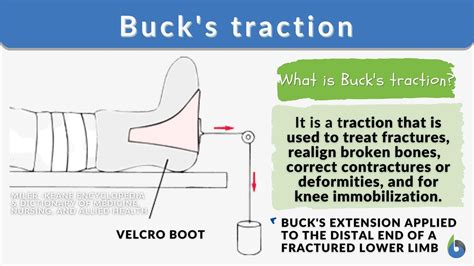 Bucks Traction Definition And Examples Biology Online Dictionary