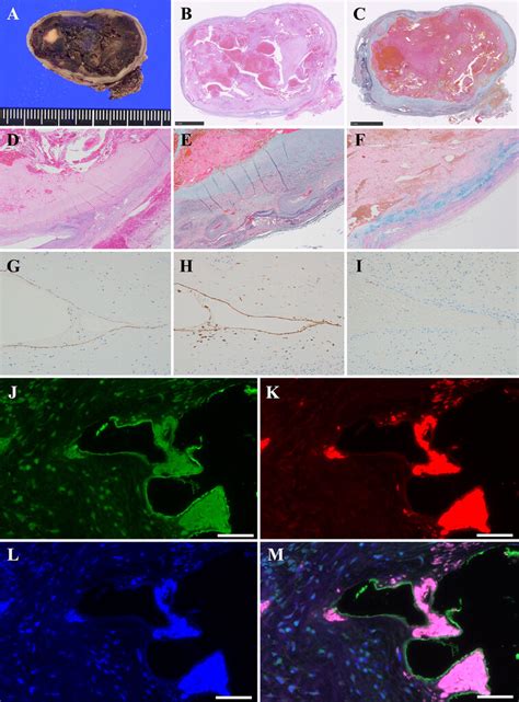Recurrence Of An Extracranial Internal Carotid Artery Aneurysm Treated