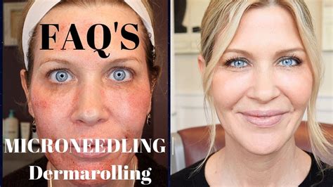 When Can You Wear Makeup After Microneedling Mugeek Vidalondon