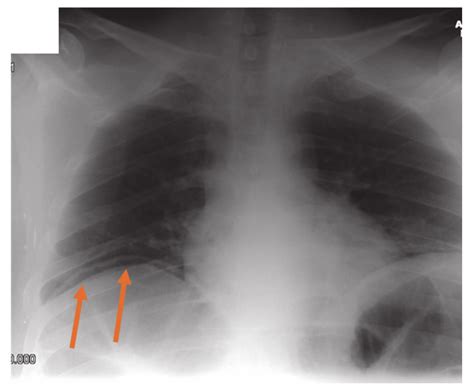 Chilaiditis Syndrome—what Every Endoscopist Should Know