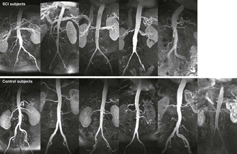 Arterial Aneurysms Thoracic Key