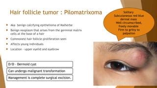 Eyelid Tumors Benign And Malignant With Management Pptx